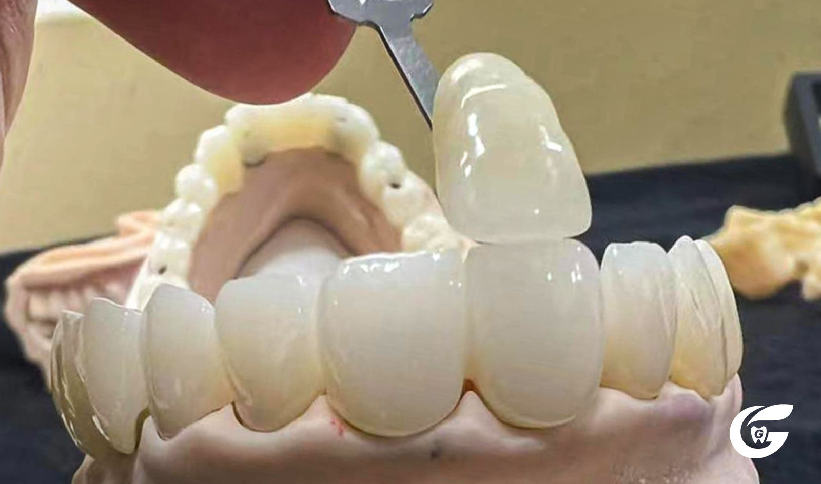 Why Zirconia Is The Best Material For Dental Restoration - Glorious ...